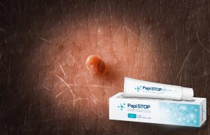 PapiStop Review | Get Rid of Warts and Papilloma | Price?