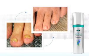 Toosy Spray - The Remedy Against Fungi and Bad Feet Smell?