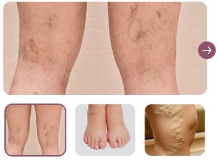 Neoveris Gel for Varicose Veins. Price, Reviews and Effects?