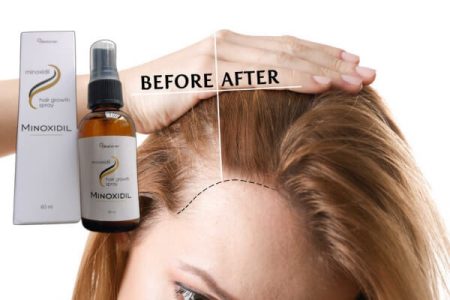 Minoxidil Review | Powerful Solution for Hair Loss? Opinions, Price